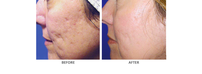 Acne Scar Treatment | Fraxel Laser For Acne Scar Removal