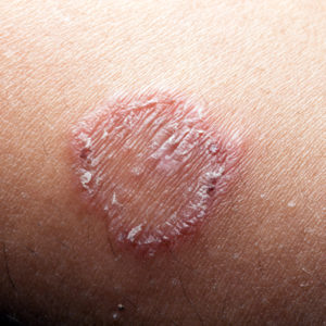Ringworm Treatment Glen Mills PA | Causes and Symptoms